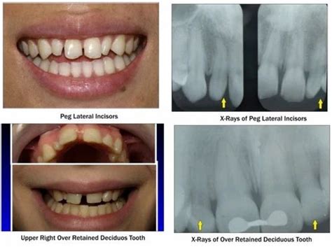 Peg Lateral In Noida ID