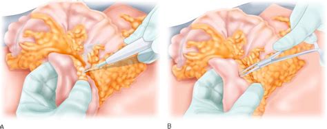 Small Intestinal Resection Open Clinical Tree