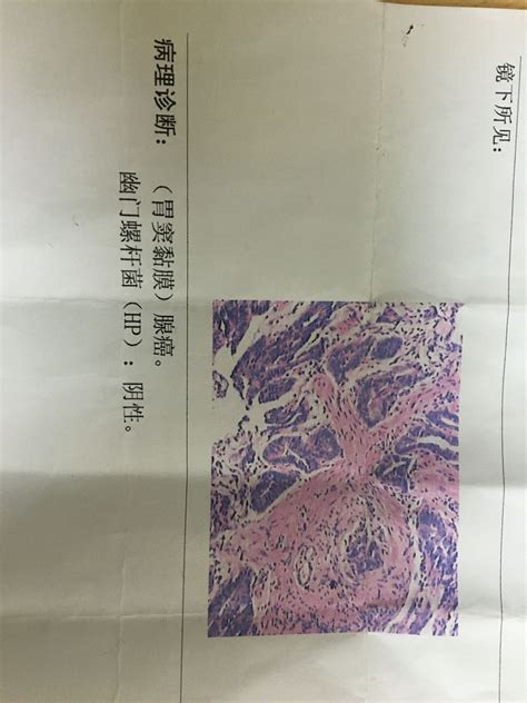 胃部恶性肿瘤一例