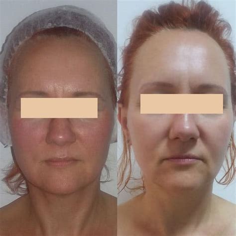 Zabieg HIFU Gdańsk skuteczny lifting twarzy Lady Beauty
