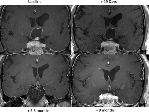 Near Total Response Of The Papillary Craniopharyngioma To Treatment