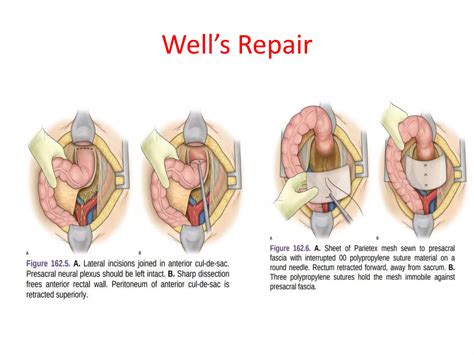 Rectal Prolapse Surgical Approaches Pptx