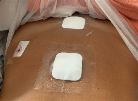 Finally Free Of 10cm Cyst Bladder Adhesions Scrolller