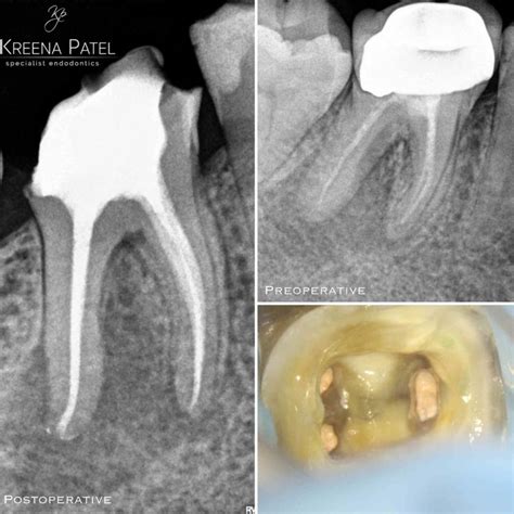 Kreena Patel On Linkedin Rootcanalretreatment Endodontics Endo