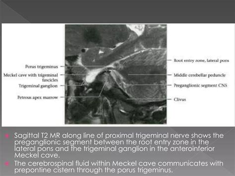 Imaging In Neurovascular Conflicts [neurovascular Compression Syndrome ] Pptx