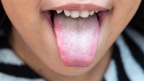 Normal Tongue Vs Thrush Thrush Oral Candidiasis Condition