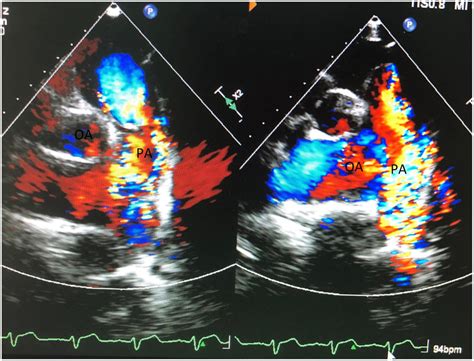 Shows Obvious High Velocity Continuous And Dominant Diastolic Aliasing