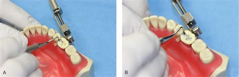 Amalgam Placement Carving Finishing And Polishing Pocket Dentistry