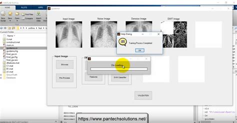 Tuberculosis Detection In Xray Images Using Matlab Image Processing