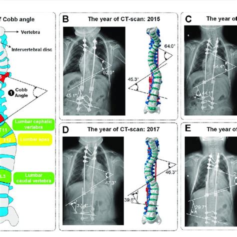 A Definition Of Cobb Angle Cobb Angle Is The Angle Of Intersection Download Scientific
