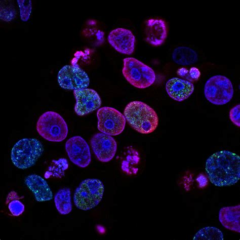 The Relationship Of Tumor Microenvironment And Clinicopathological