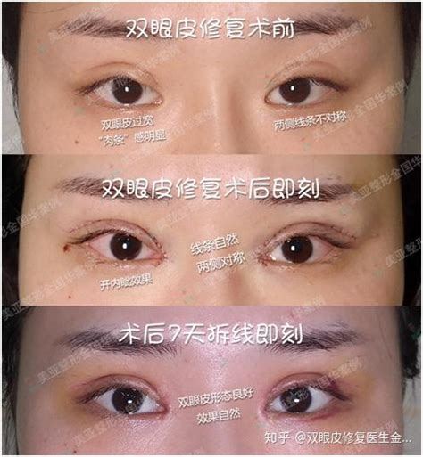 双眼皮手术失败后产生的 肉条”到底是什么?为什么割完后会显的假? 知乎 双眼皮手术失败后产生的 肉条”到底是什么?为什么割完后会显的假? 知乎