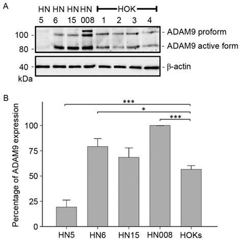 Overexpression Of Adam9 In Oral Squamous Cell Carcinoma Pmc