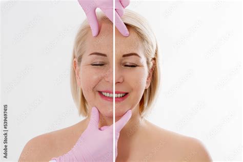 Closeup Woman Middle Age Face Before After Collagen Face Injection