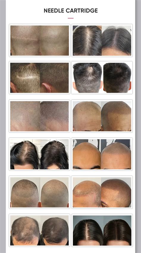 Factory Customise Logo Auto Scalp Micropigmentation Machine Pmu Smp Practice Head Tattoo Gun Factory Customise Logo Auto Scalp Micropigmentation Machine Pmu Smp Practice Head Tattoo Gun