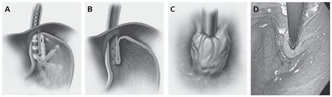 Dor Fundoplication Degrees