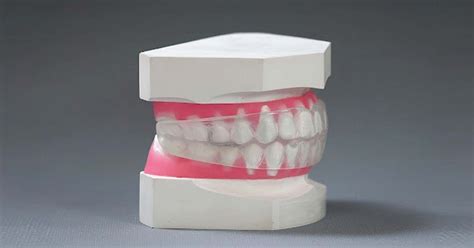 Types Of Retainers In Dentistry Removable Vs Permanent Dentalkart