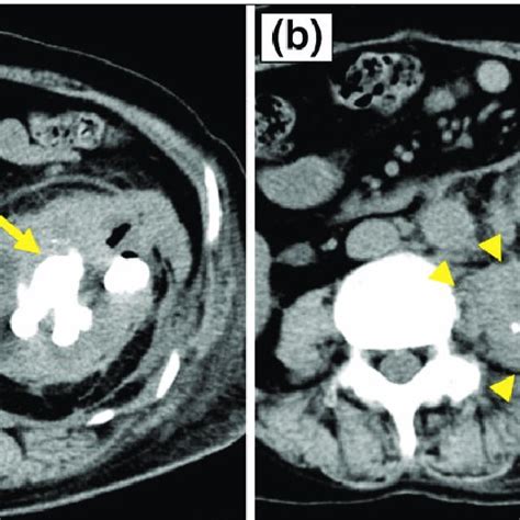 Abdominal Ct Showed A Staghorn Calculus A Arrow In The Left Renal Download Scientific