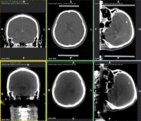 Cone Beam Radiation Therapy The Best Picture Of Beam