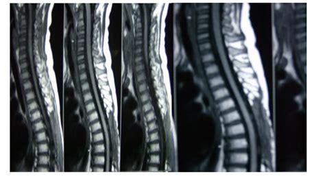 Primary Intraspinal Primitive Neuroectodermal Tumor Pnet A Rare Occurrence Medcrave Online