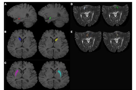 Figure 1 From Development And Validation Of A Plasma FAM19A5 And MRI