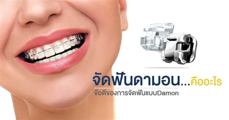 จัดฟันดามอน คืออะไร ข้อดีของการจัดฟันแบบ Damon ศูนย์ทันตกรรม Bidc