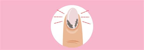 Allergische Reactie Van Nagels Ontdek De Oorzaken Symptomen En Voorkom Herome Cosmetics