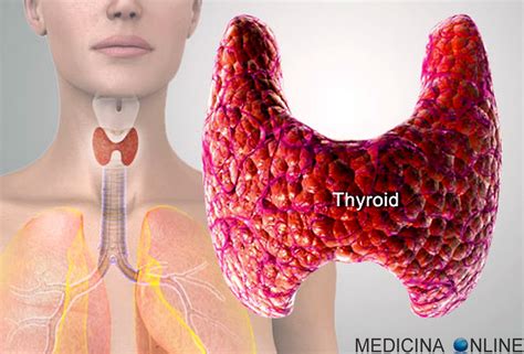 MEDICINA ONLINE TIROIDE NODULO IPOTIROIDISMO IBSA EUTIROX ORMONI