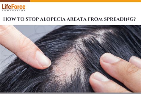 How To Stop Alopecia Areata From Spreading Homeopathic Treatment And