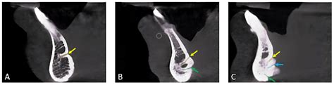 Lingual Foramen