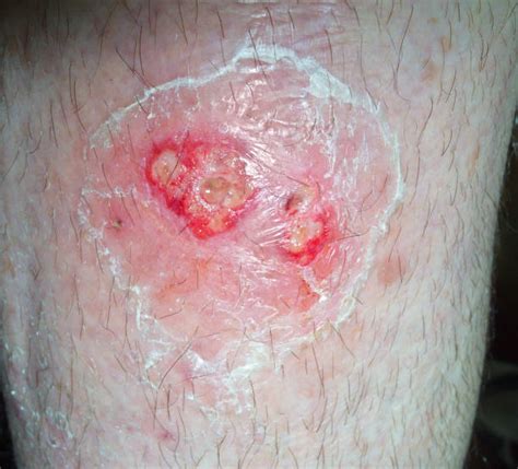 Ingrown Hair Staph Infection