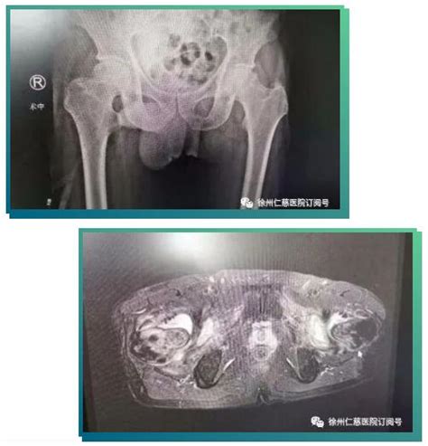 【智慧骨科】骨科机器人精准辅助，微创完成股骨头坏死髓芯减压术 骨科机器人 徐州仁慈医院 徐州仁慈医疗集团