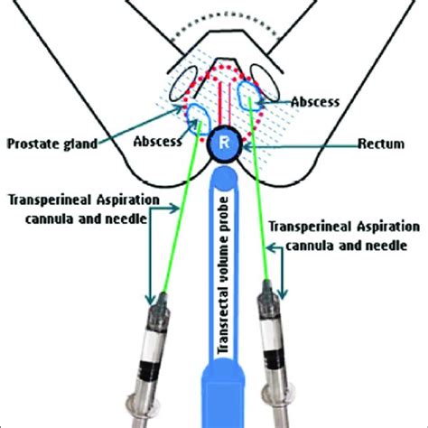 Diagram Demonstrating Transrectal Sectional Sonography Of Prostatic