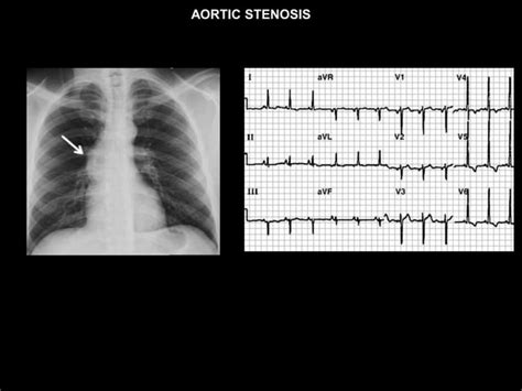 Aortic Stenosisppt