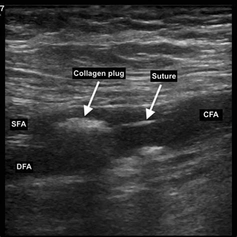Ultrasound Image Of The Left Groin Demonstrating Echogenic Structure At Download Scientific