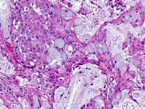 Mucoepidermoid Carcinoma Lung KiKo XP
