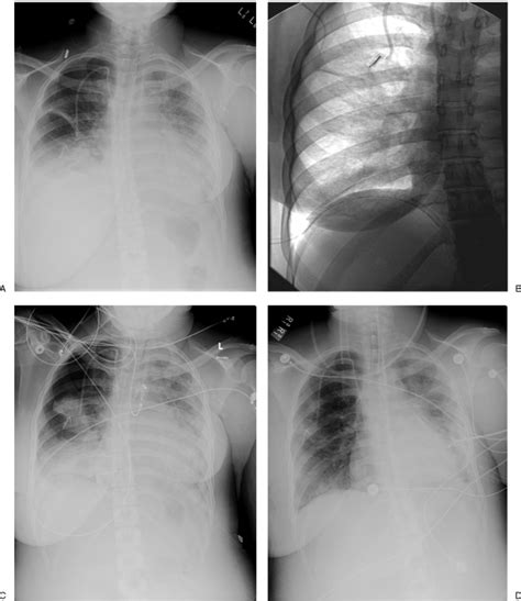 “ex Vacuo” Pneumothorax Pmc