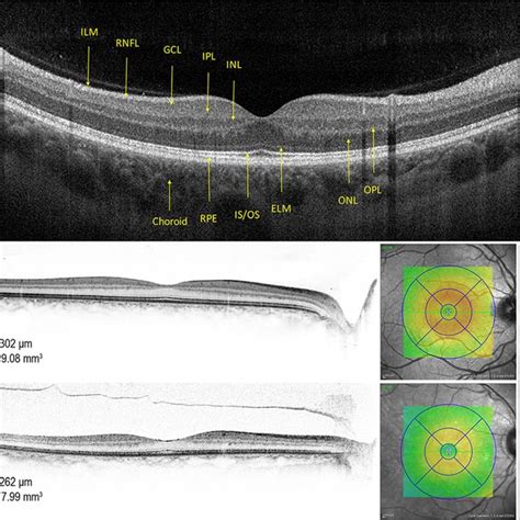 Oct Visualizes The Different Retinal Layers On Crosssectional Sd Oct Download Scientific