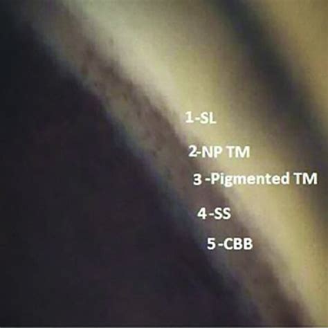 Normal Trabecular Meshwork 1 Schwalbe S Line 1 Nonpigmented