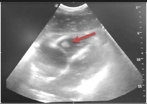 Subxiphoid View Showing A Clot In Transit In The Right Ventricle Arrow