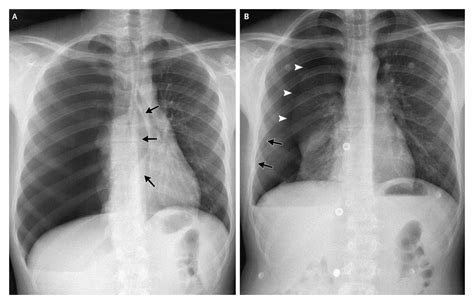 Tension Pneumothorax