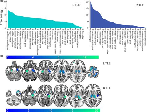 Structural Remodeling In Lateralized Tle Patterns Main Effects Of
