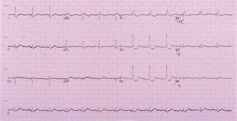 Twelve Lead Ecg Demonstrating St Depression In V2 V4 And Rbbb With Rsr