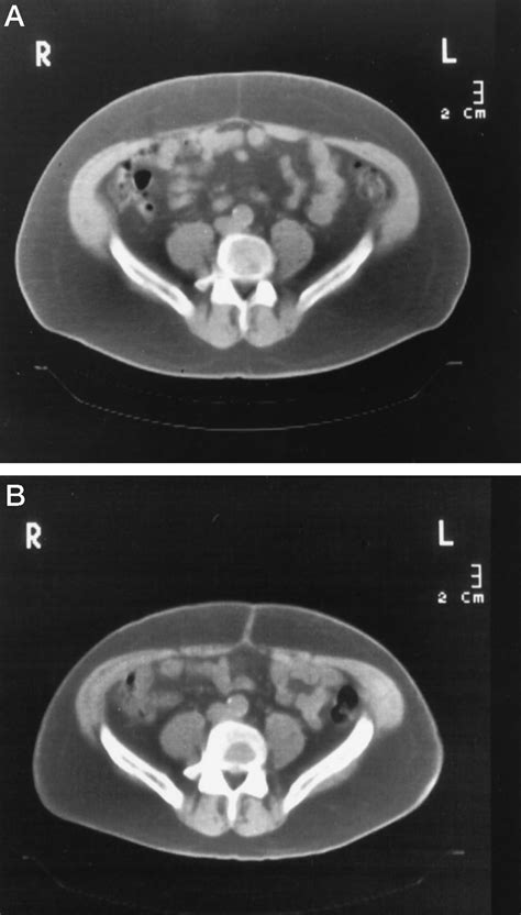 Abdominal Sc And Visceral Adipose Tissue Determined With Computed