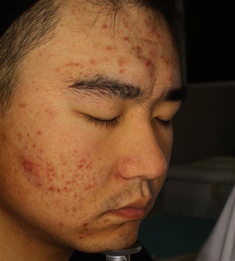 Acne04 Object Detection Model V1 2023 01 30 12 23pm By Andrei Dore