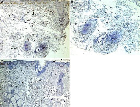 A Immunohistochemical Staining For Foxp3 Showing Negativity In Aa