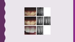 Apexogenesis And Apexification PPTX