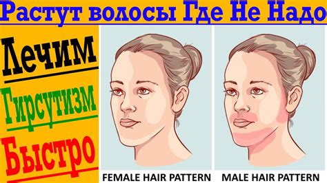 Растут волосы Где НЕ НАДО Гирсутизим избыточный рост волос Youtube
