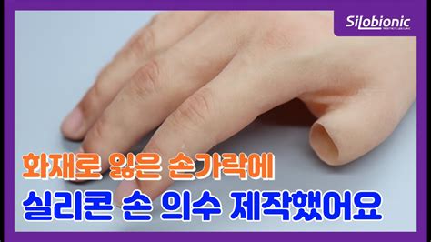 화상으로 잃은 손가락에 실리콘 손 의수 제작했어요 Youtube