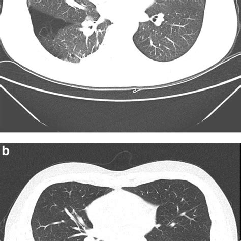 Thoracic Ct Of Case 2 A Ct Image Of Pneumothorax With A Cluster Of